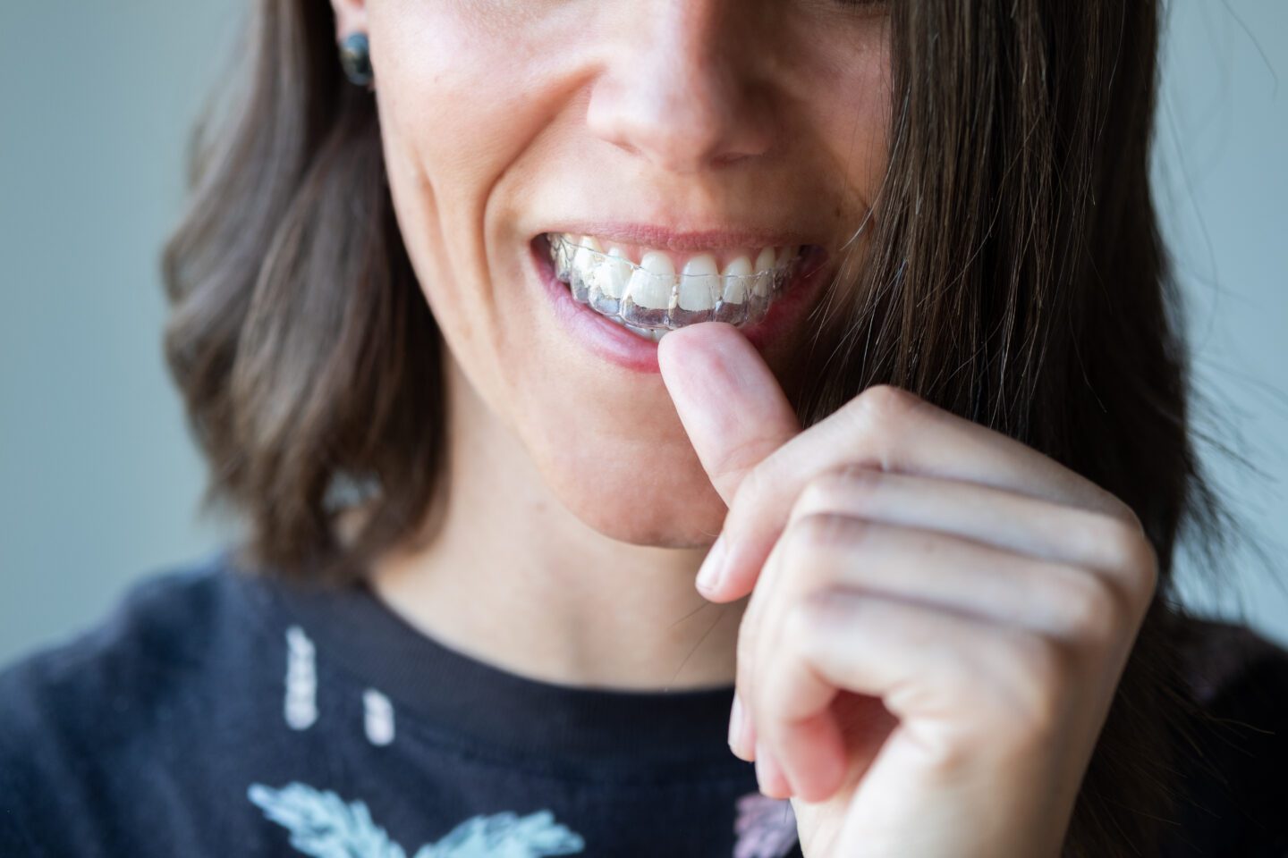 Invisalign Near Me in Huntsville: Expert Providers for Clear Braces
